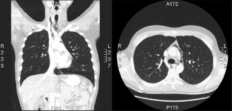 BENEFICIOS DEL TAC DE PULMÓN – Cemediam