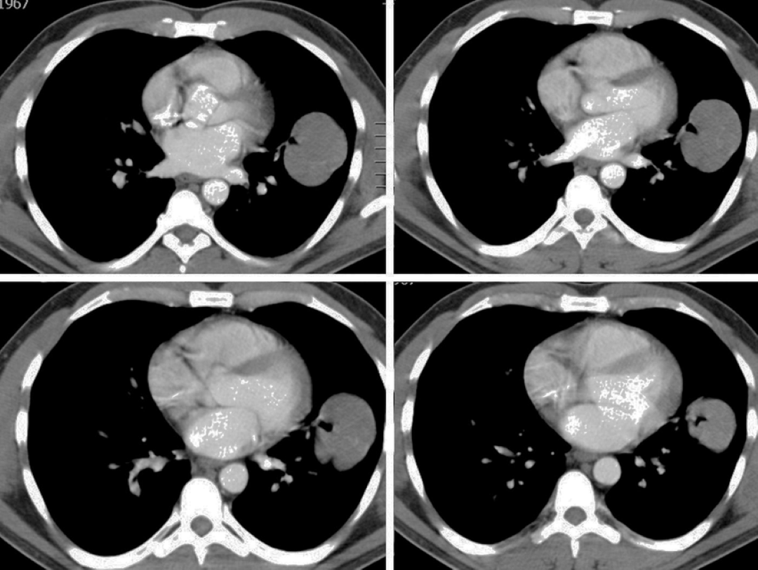 BENEFICIOS DEL TAC DE PULMÓN – Cemediam